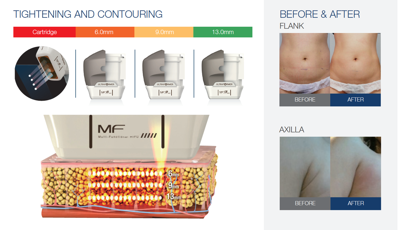 Transducers/Cartrige Body 6,0mm - astomed.no